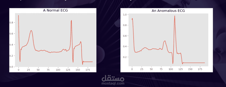ECG signal anomaly detection | مستقل