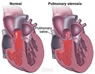Pulmonary valve obstruction | مستقل