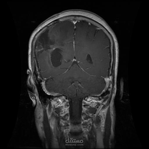 Brain Tumor Detection Using Cnn مستقل