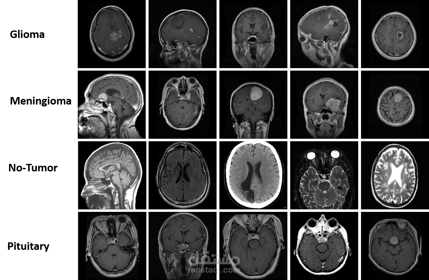 Brain Tumer Classification | مستقل