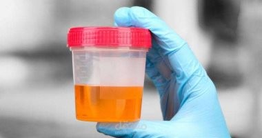 urine protein sulfosalicylic acid precipitation test (SSA) | مستقل